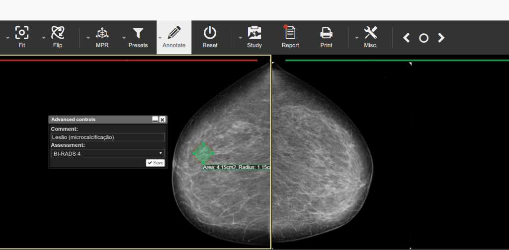 Automatic Detection Of Microcalcifications In Mammography Bmd Software